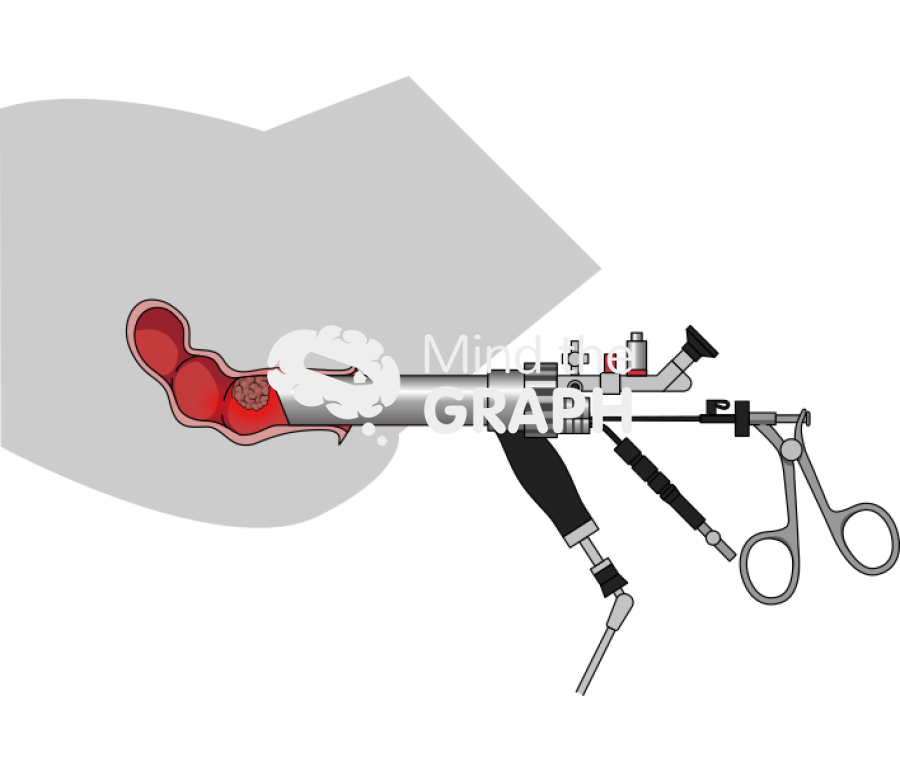 Transanal endoscopic cancer longitudinal shape cut