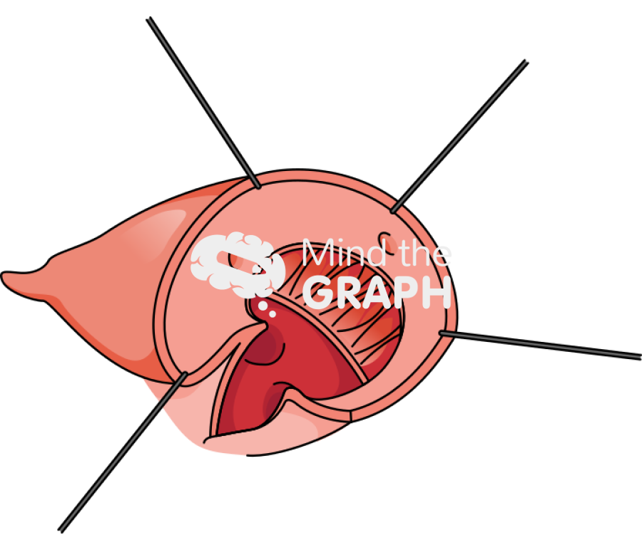 Transcatheter aortic valve explant commando reconstruction ...