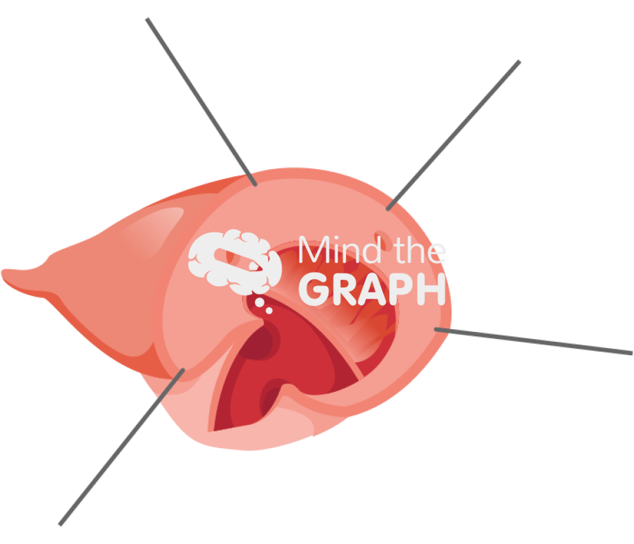 Transcatheter aortic valve explant commando reconstruction ...