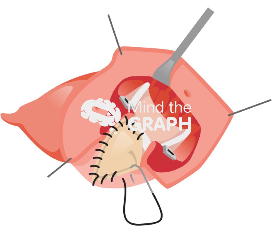 Free Transcatheter aortic valve explant commando reconstruction ...