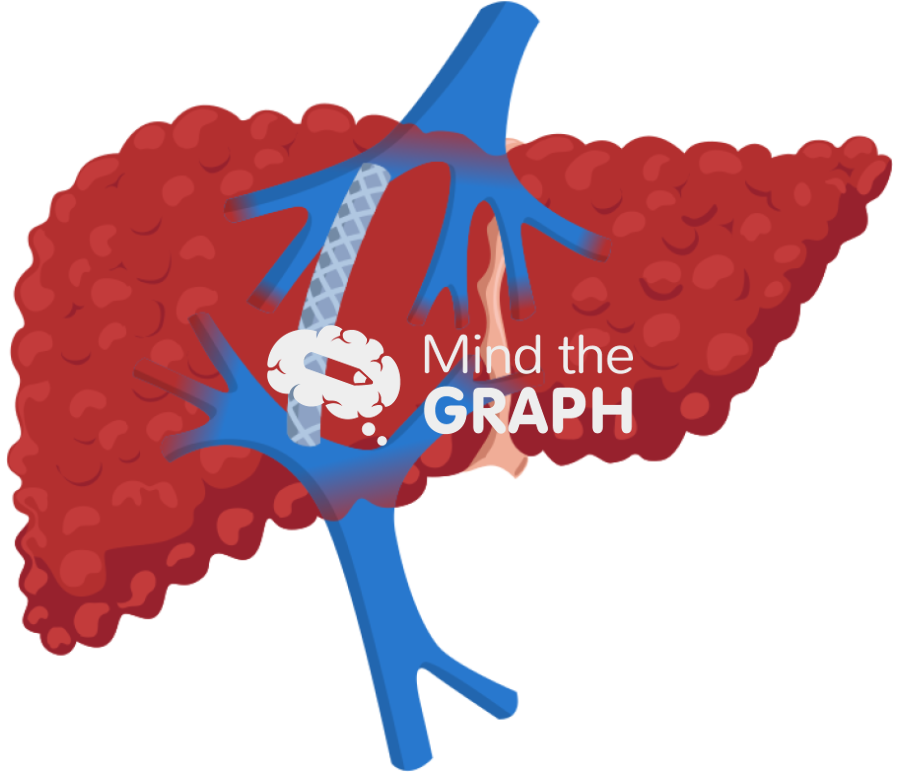 Free Transjugular intrahepatic portosystemic shunt tips cirrhotic liver ...