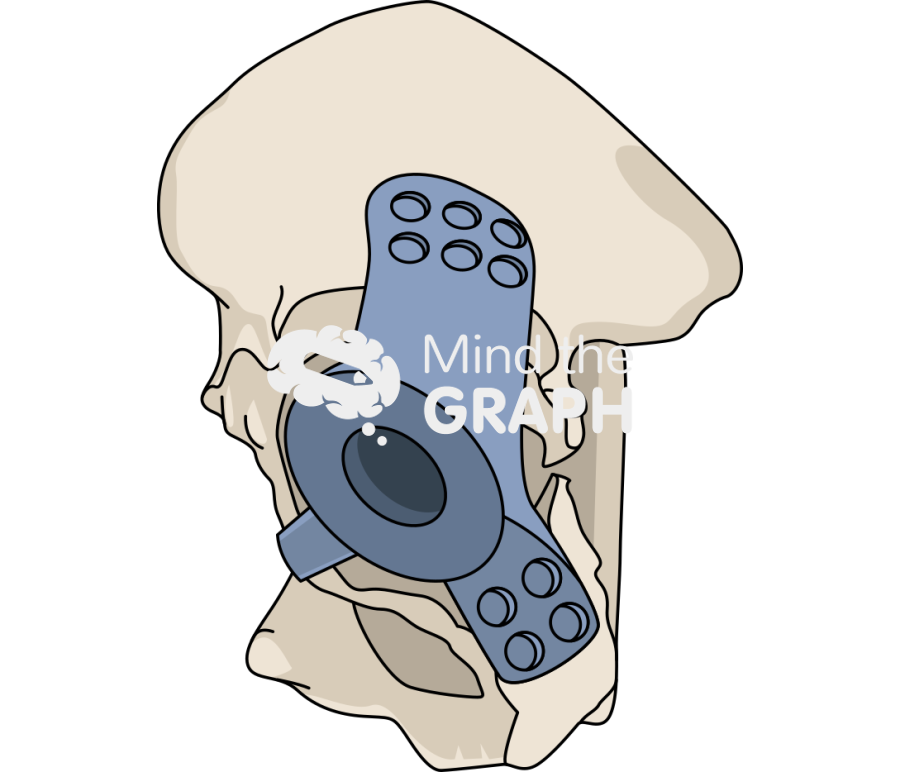 Free Triflange acetabular component Icons, Symbols, Pictures, and ...