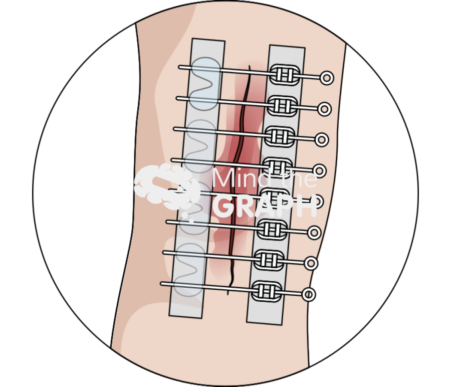 Zipline surgical skin closure